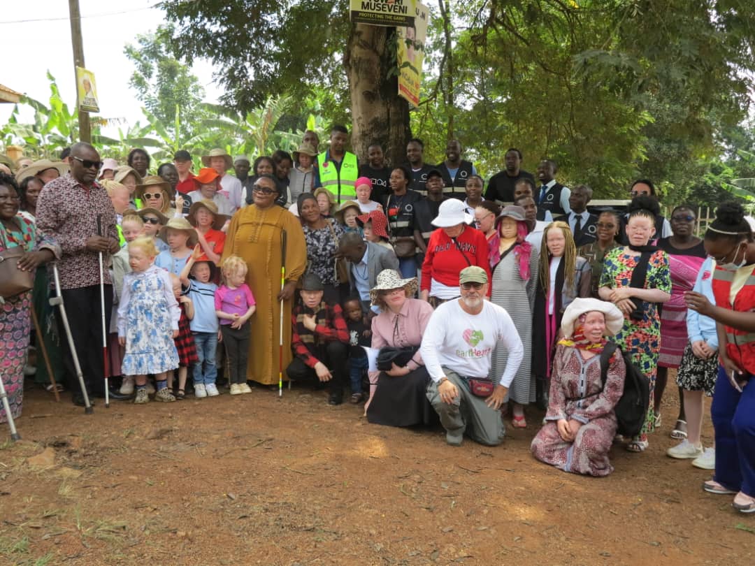 Persons with Albinism Call for Increased Employment Opportunities in ...